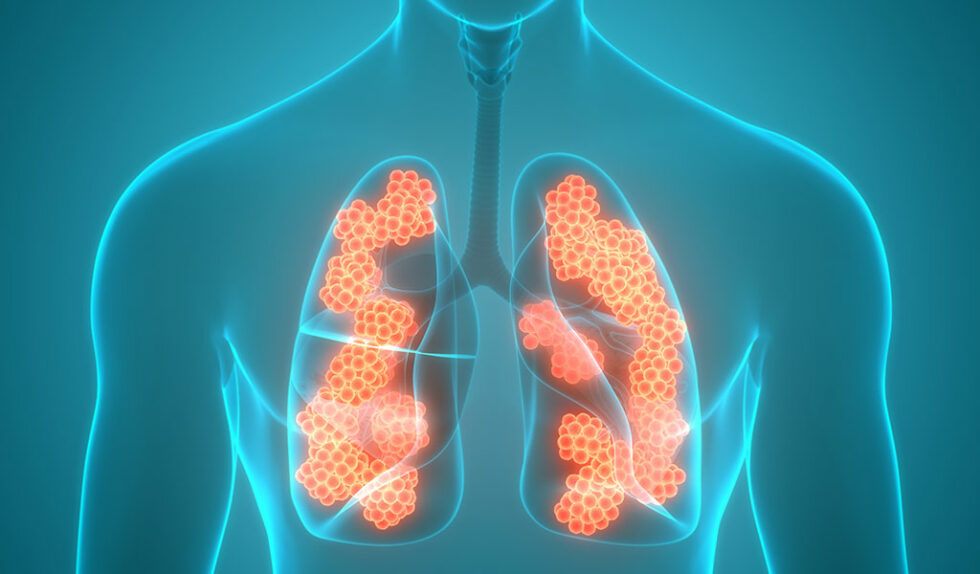 Lungenemphysem bei COPD – Was tun? - LEICHTER ATMEN